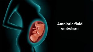 What is the Meaning of Amniotic Fluid Embolism? - Kaisermagazine