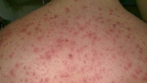 What is Toxic Epidermal Necrolysis? - Kaiser Magazine