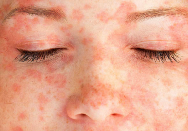 What is Toxic Epidermal Necrolysis? - Kaiser Magazine