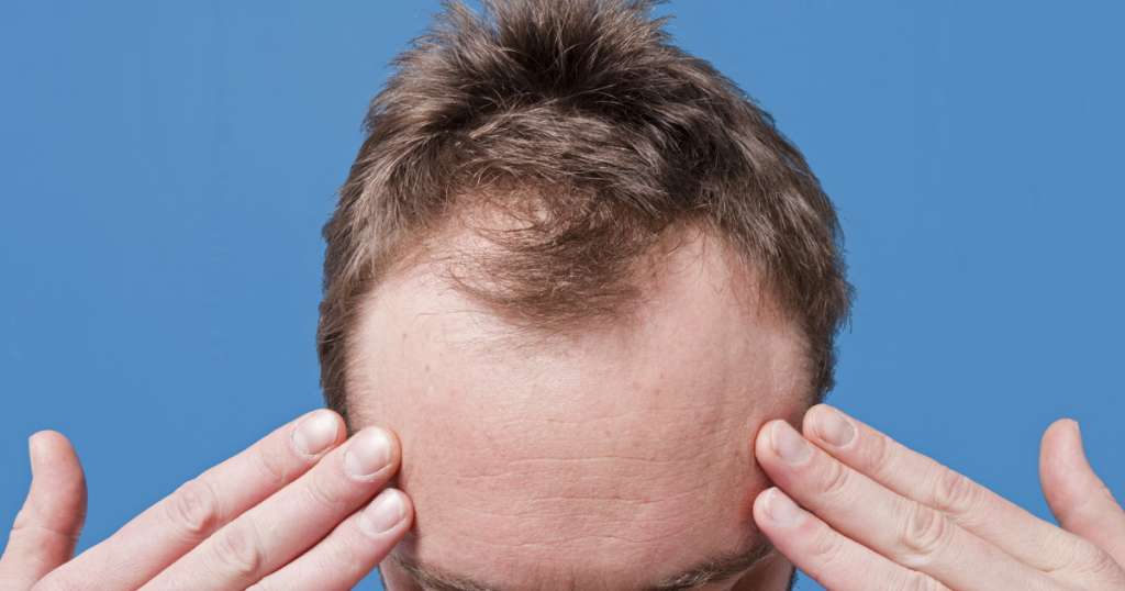 How To Deal With Male-Pattern Baldness